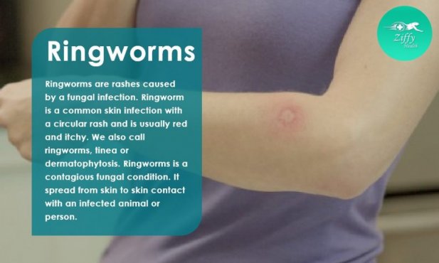 Human Ringworm Symptoms